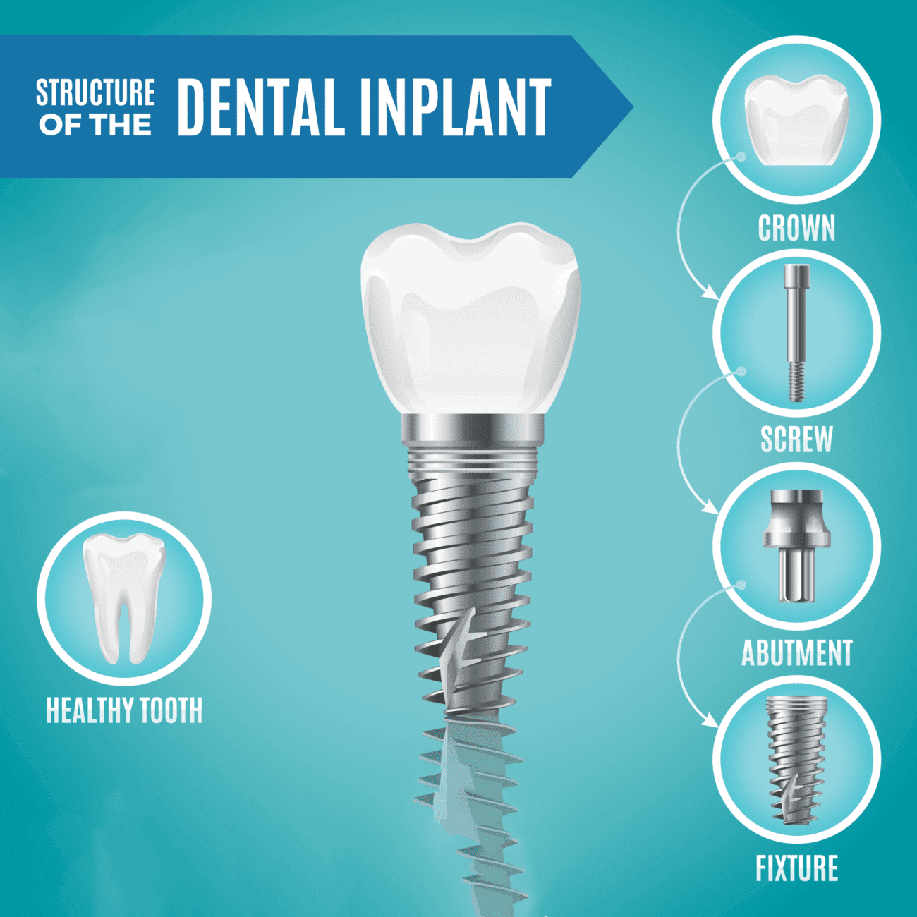 Components of a Dental Implant - Restorative Dentist in Hanover, MD